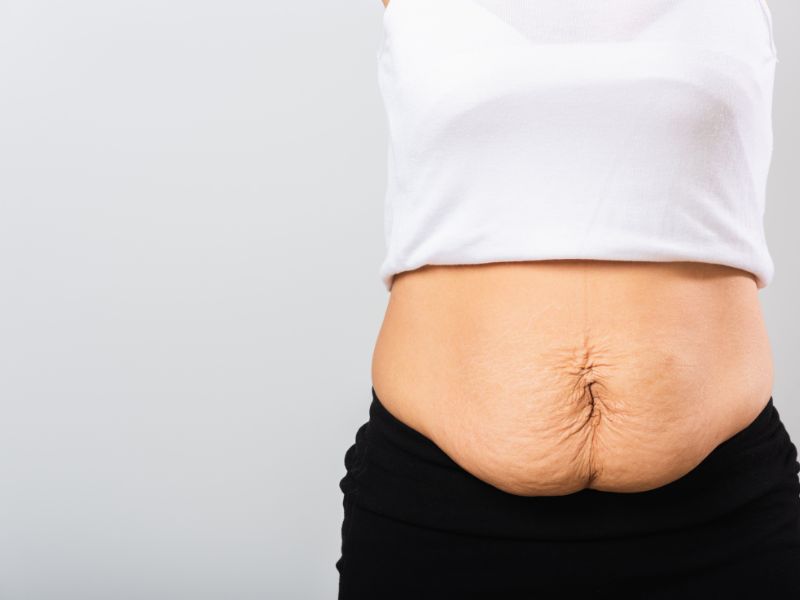 Antes e Depois da Dermolipectomia: Transforme Sua Autoestima